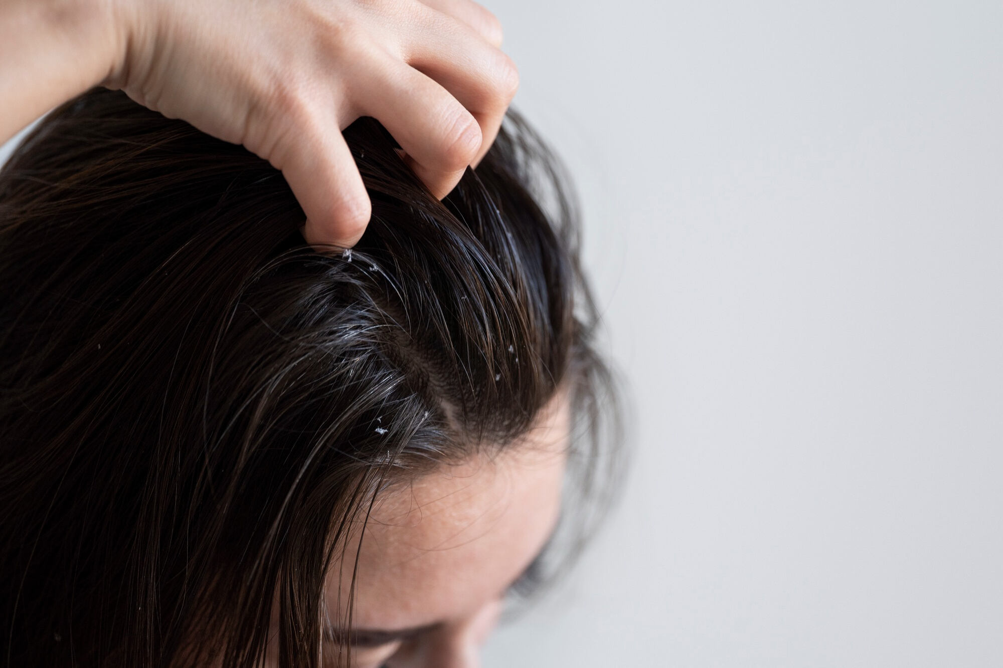 Causes And Solutions To Treat Oily Scalp Easily Fitie Articles 1775