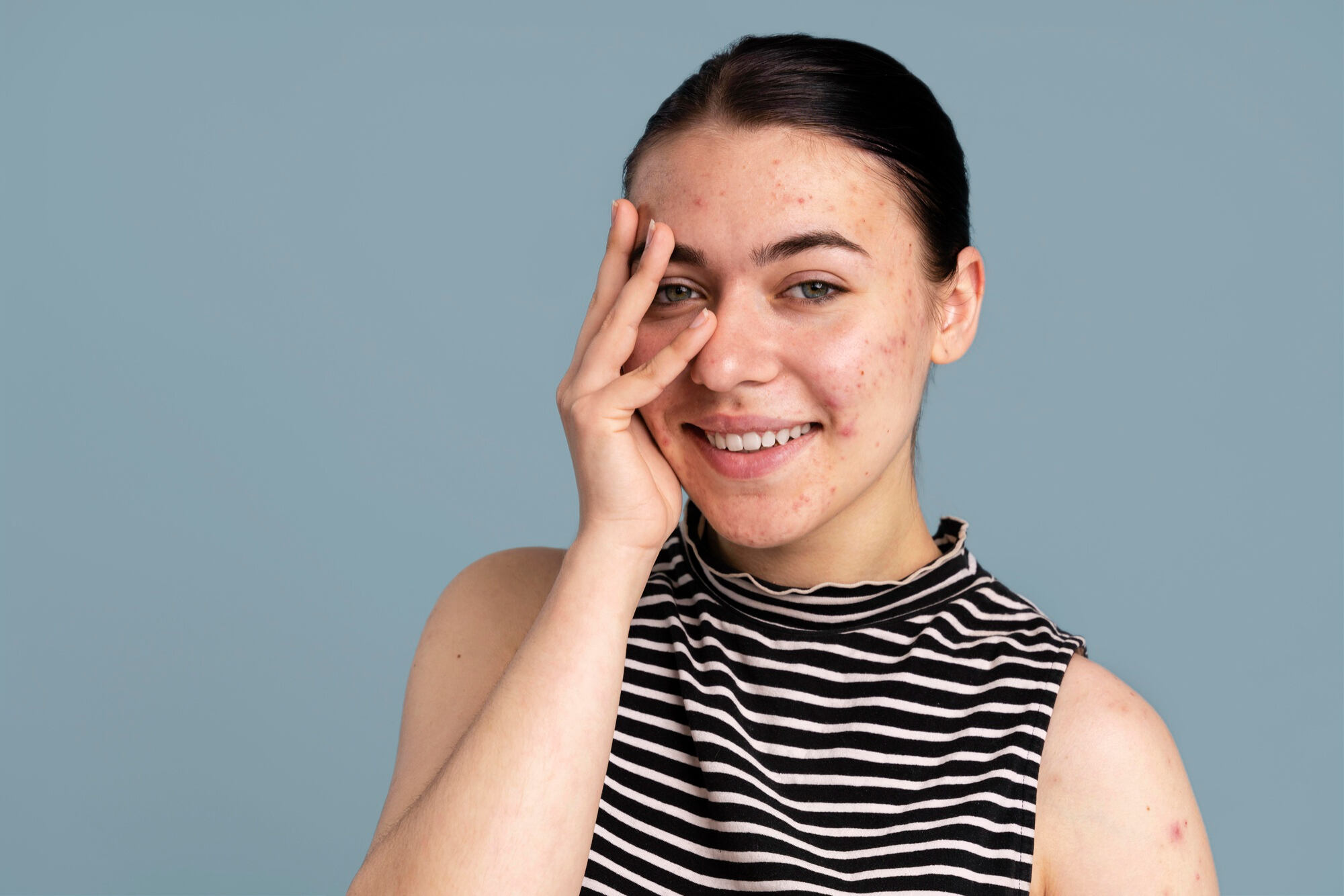 Milia dan Fungal Acne: Kenali Apa Saja Perbedaannya :: Fitie :: Artikel